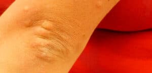 Cuidados de codos resecos - Cuidados Caseros